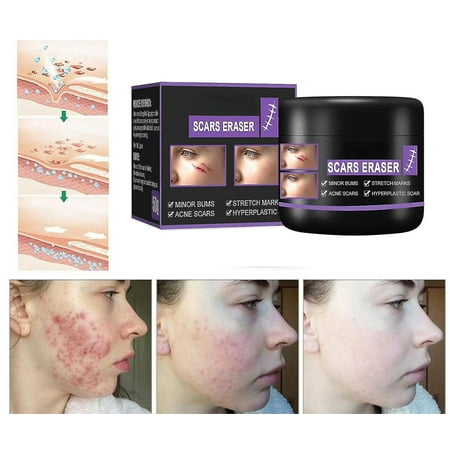 Scar Repair Cream Lightening Post-operative Scars Smoothing Skin ...