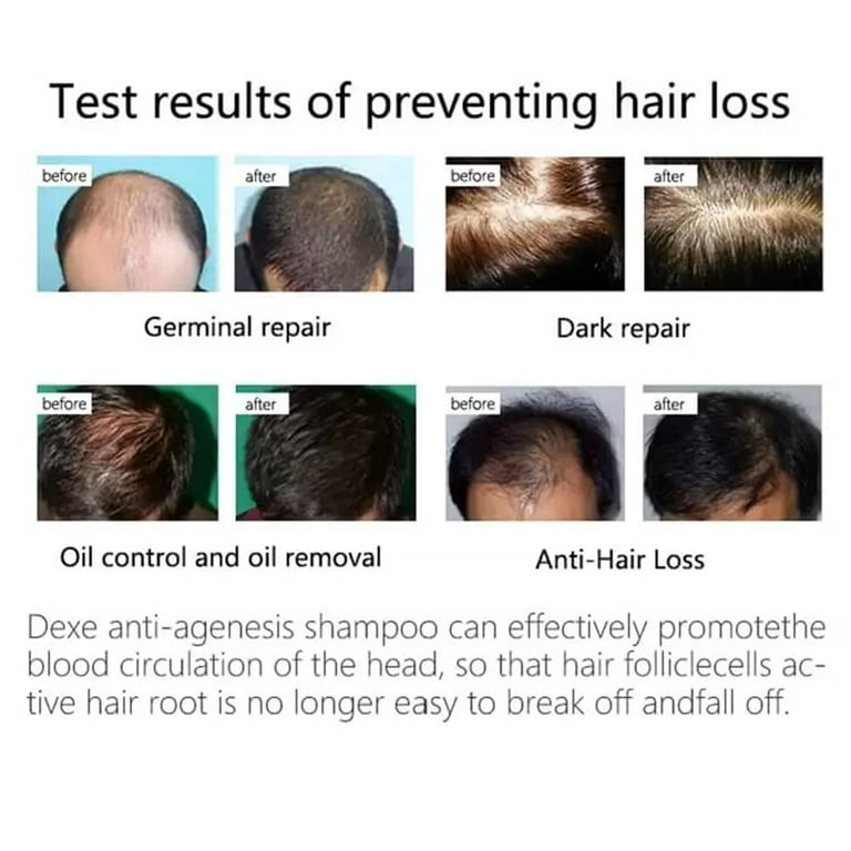 Hair Density Test
