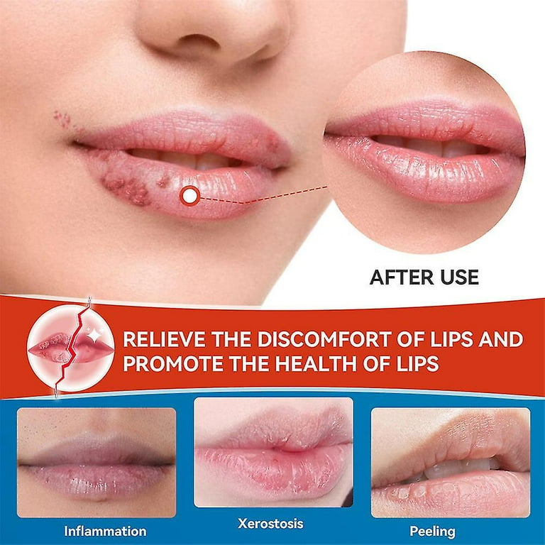 Cold Sore On Lip Treatment