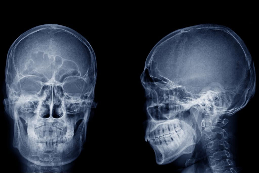 Human Skull X ray Image Front and Side Lateral View Skeleton Anatomy ...