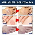 30ml Psoriasis Treatment Spray Hand Foot Scalp Eczema Tinea Anti Itch