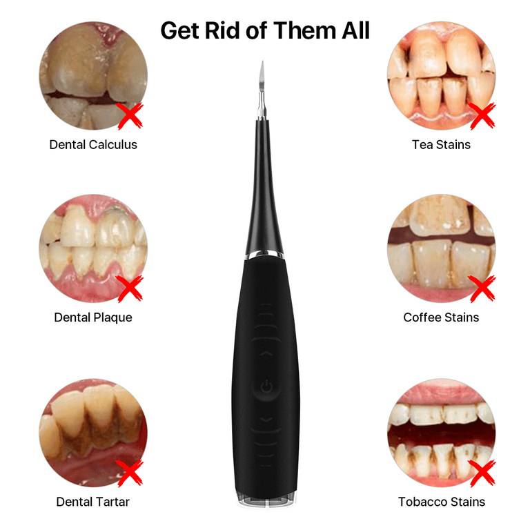 Black Calculus Teeth