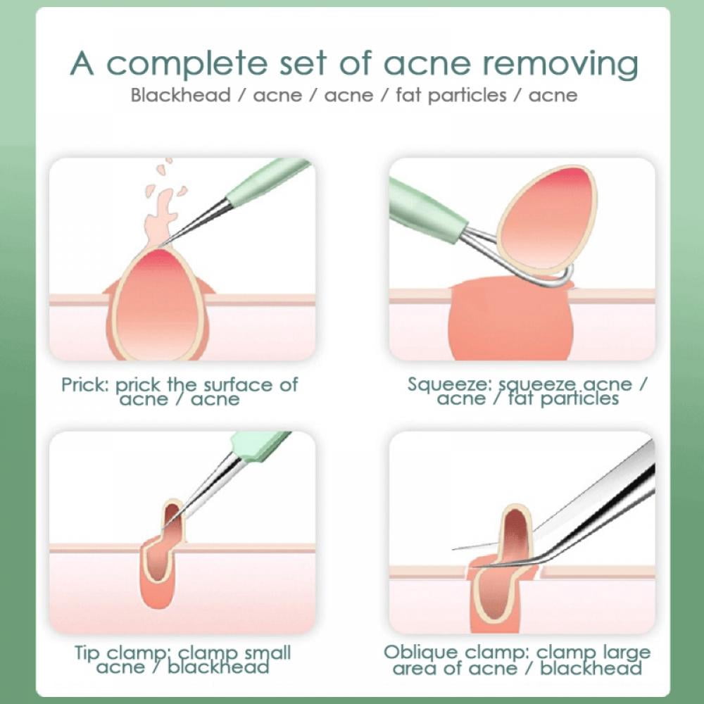 Blackhead Removal Diagram
