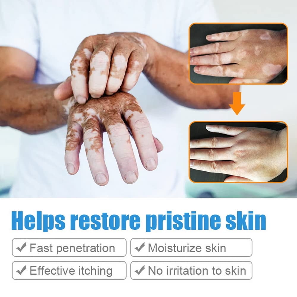 Buy KanyeHB Vitiligo Cream, Vitiligo Treatment, Vitiligo Skin Care ...