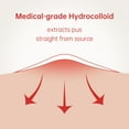 JVR Acne Patches, 90 Medical-Grade Hydrocolloid Pimple Patches ...