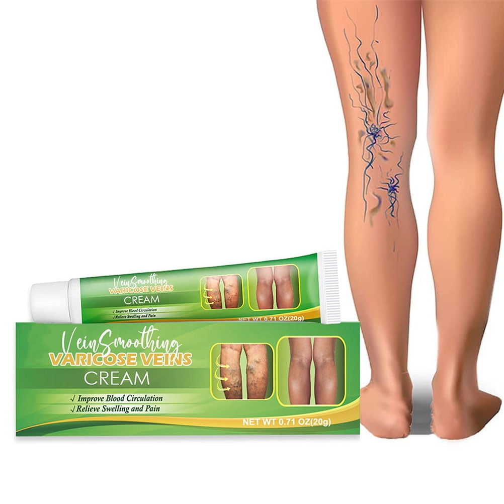 Crema eficaz para aliviar las varices, las arañas vasculares, la ...