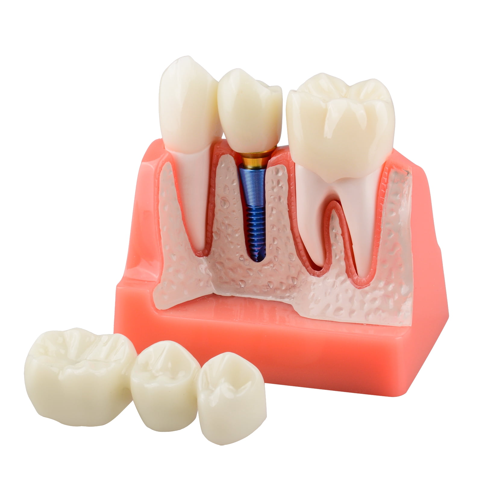 Dental Implant Model for Patient Education, 4 Times Dental Implant ...