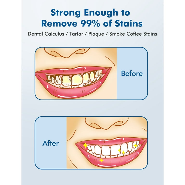 Black Calculus Teeth