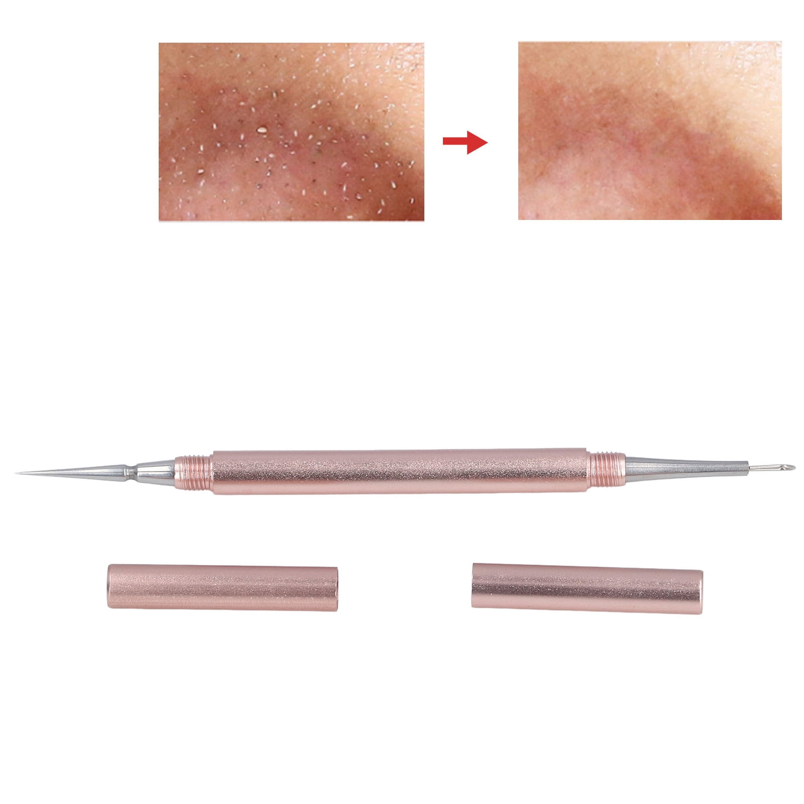 Click here for Ymiko Double Ended Facial Milia Removal Needle  Po... prices