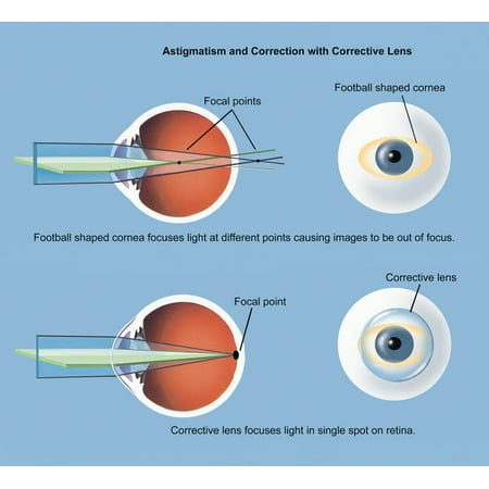 Astigmatism and correction with corrective lens Poster Print by ...
