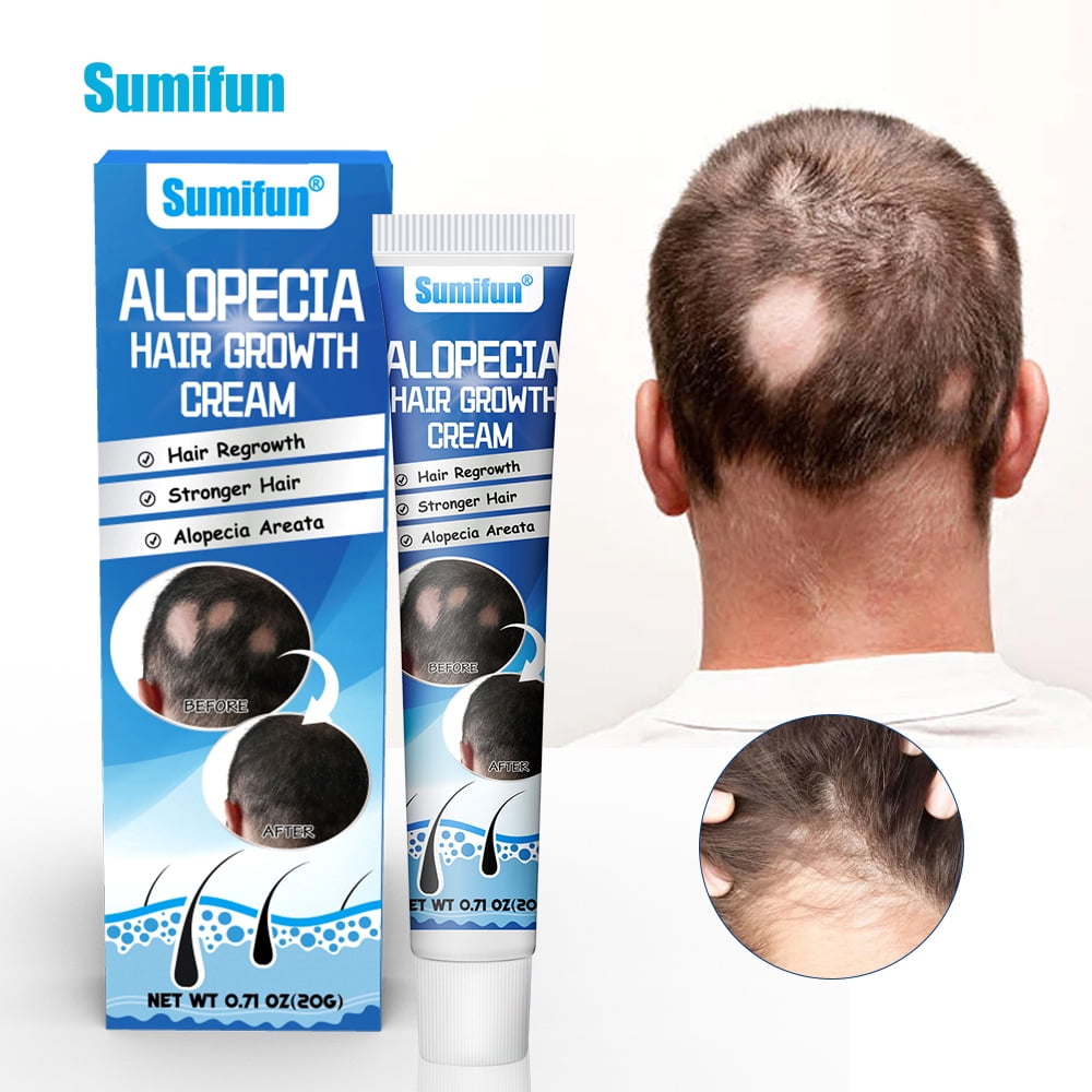 alopecia areata cream head skin care cream hair care - Walmart.ca
