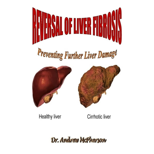 Reversal of Liver Fibrosis : Preventing Further Liver Damage (Paperback ... Reversal of Liver Fibrosis : Preventing Further Liver Damage (Paperback ...