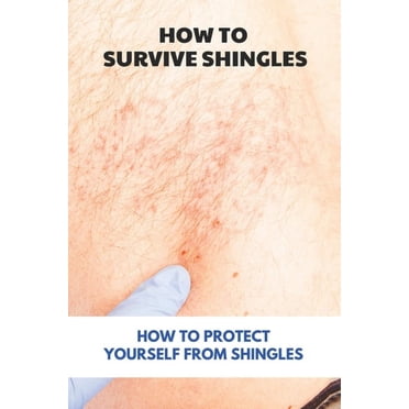 Shingles Home Remedies: Treatment For Itching And Pain: Shingles ...