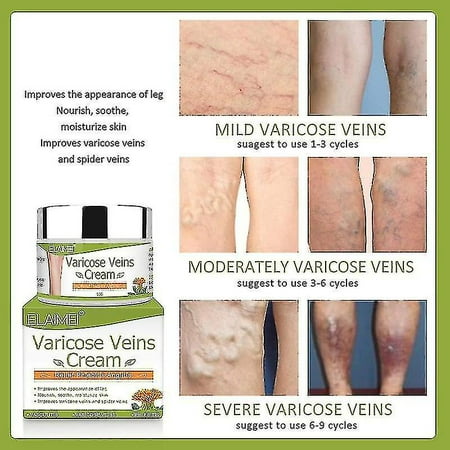 50g Varicose Vein Ointment Relieve Pain Bulging Legs Red Blood Streak ...