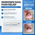 CurveCorrect Ingrown Toenail Corrector Kit, 10 Braces, Pain Relief ...