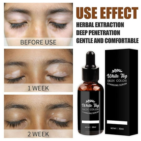 White Tag Skin Color Changing Serum Vitiligo Moisturizing Treatment ...
