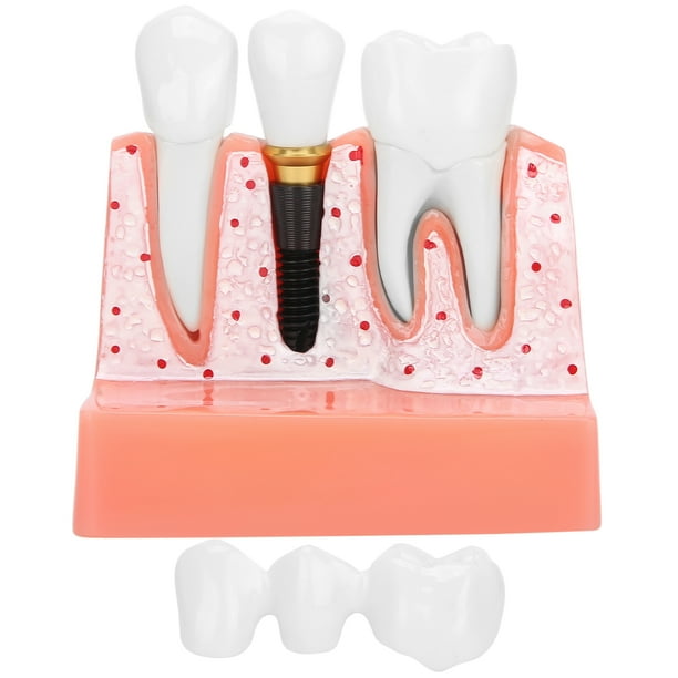 Modelo de puente de corona dental, modelo de dientes Implante dental ...