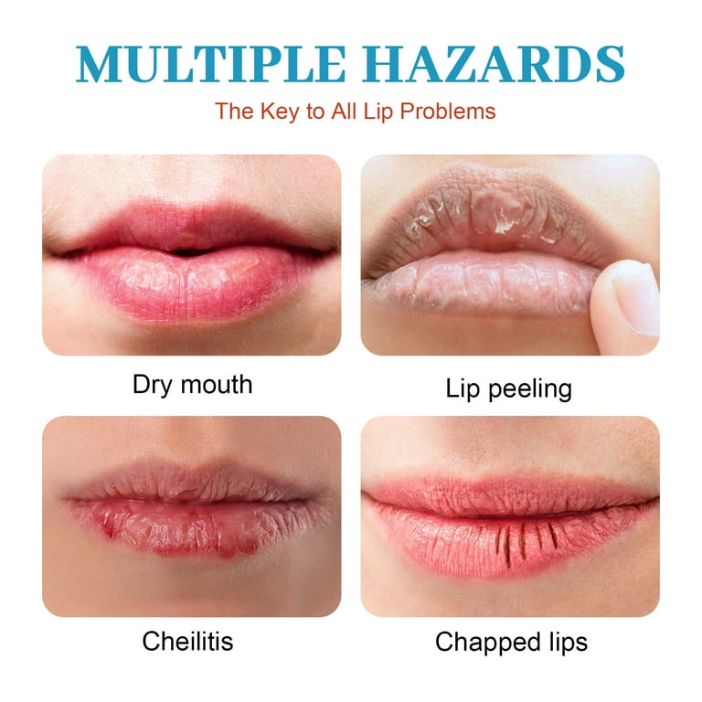 Severely Chapped Lips Dry Cracked Lips Healing Lip Balm For Severely