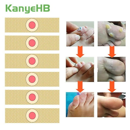 24pcs Foot Care Medical Plaster Foot Corn Removal Calluses Plantar ...