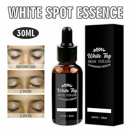 Depigmented Vitiligo Leukoplakia Skin Treatment Melanin Essence Serum ...