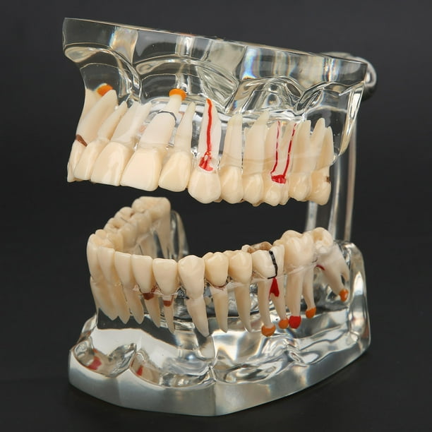 Teeth Study Teaching ModelTransparent Disease Teeth Model Dental ...