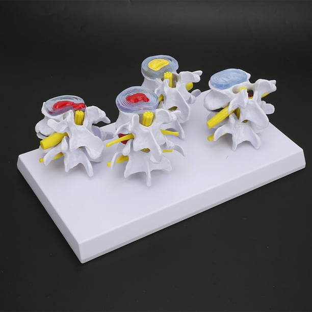 Anatomical Human Lumbar Vertebrae,4-stage Medicals Human Lumbar ...