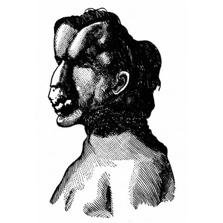 Joseph Merrick (1864-1890). /Nenglish Medical Anomaly, Known As The ...