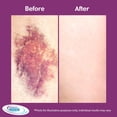 Miracle Plus Arnica Healing and Swelling Relief Bruise Cream, 4 oz ...