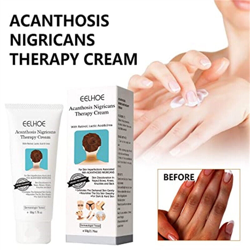 Acanthosis Nigricans Armpit Treatment