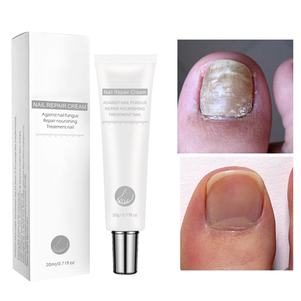 Buy OZS 20G Fungus Nail Cream Nail Fungus Anti Fungal Nail Cream Online ...
