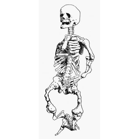 Rickets. /Nextreme Deformity Of The Skeleton Of A 21 Year-Old Native ...