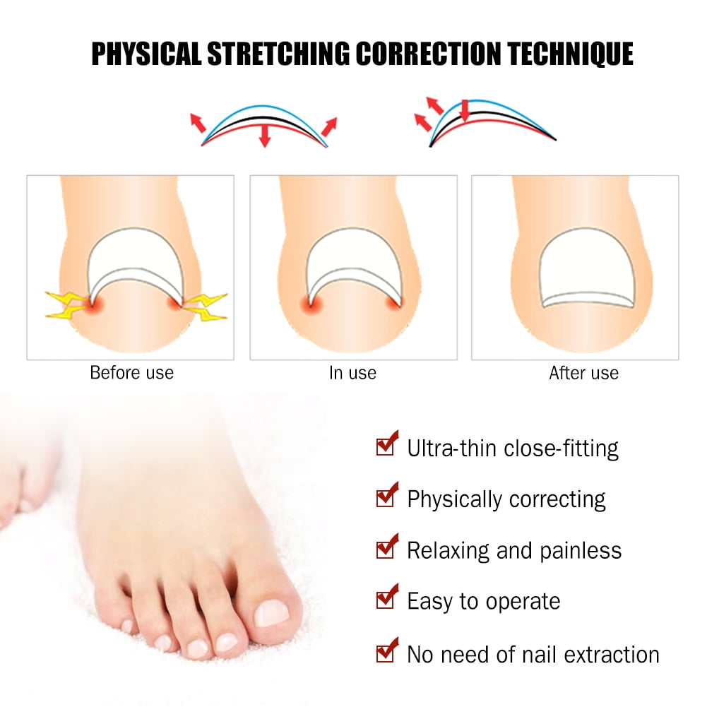 Ingrown Toe Nail Fixer Professional Pedicure Tool Set Toe Nail Trimer ...
