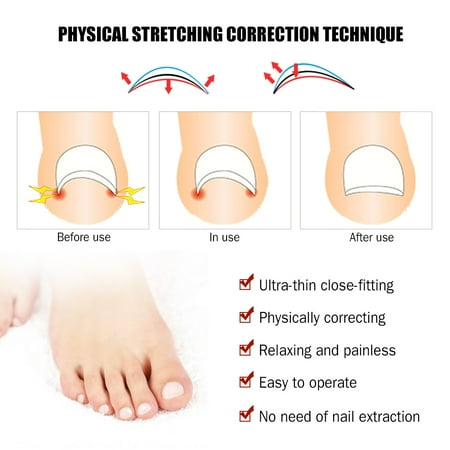 Toenail Correction Tool Ingrown Toe Nail Fixer Ingrown Toenail ...