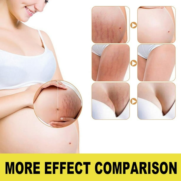 Pregnancy Repair Cream, Lightening and Preventing Fat Lines, Growth Lines, Orange Peel, Belly ...