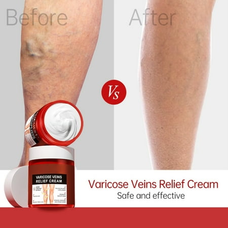 Calf Muscle Care Cream for Varicose Legs Varicose Veins Cream Calf ...