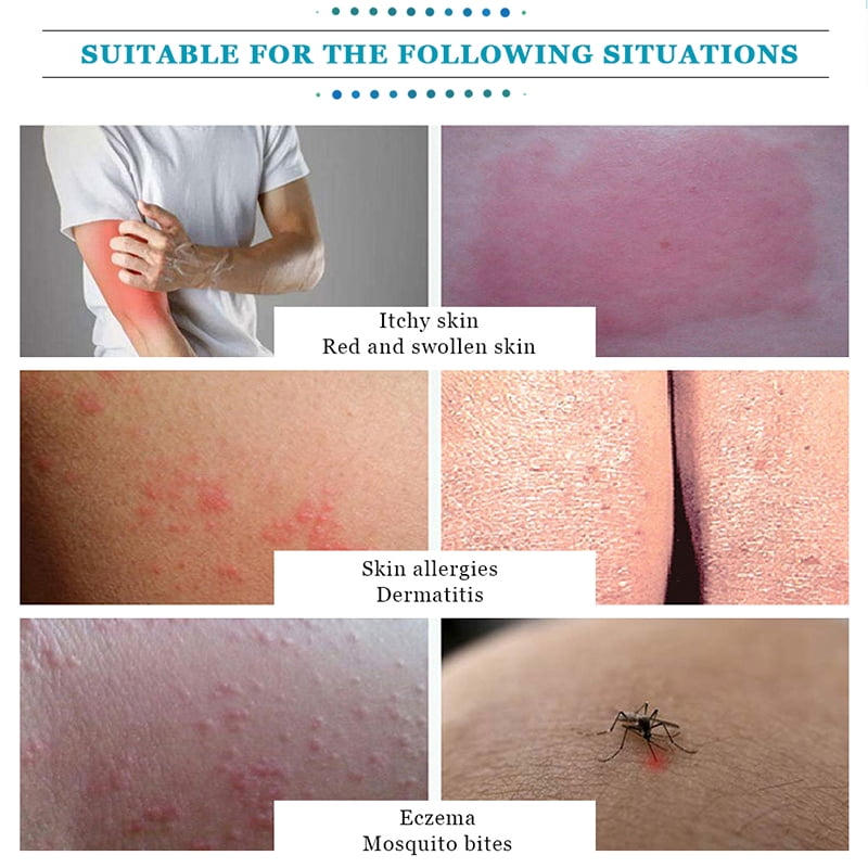 20G Skin Rash Cream Eczema Ointment Anti-Fungal Cream Psoriasis ...