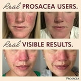 Prosacea Rosacea Treatment Gel 0.75 Oz 2-Pack - Walmart.com