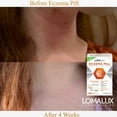 Loma Lux Eczema Pill - Dermatologist Developed, Natural Eczema ...