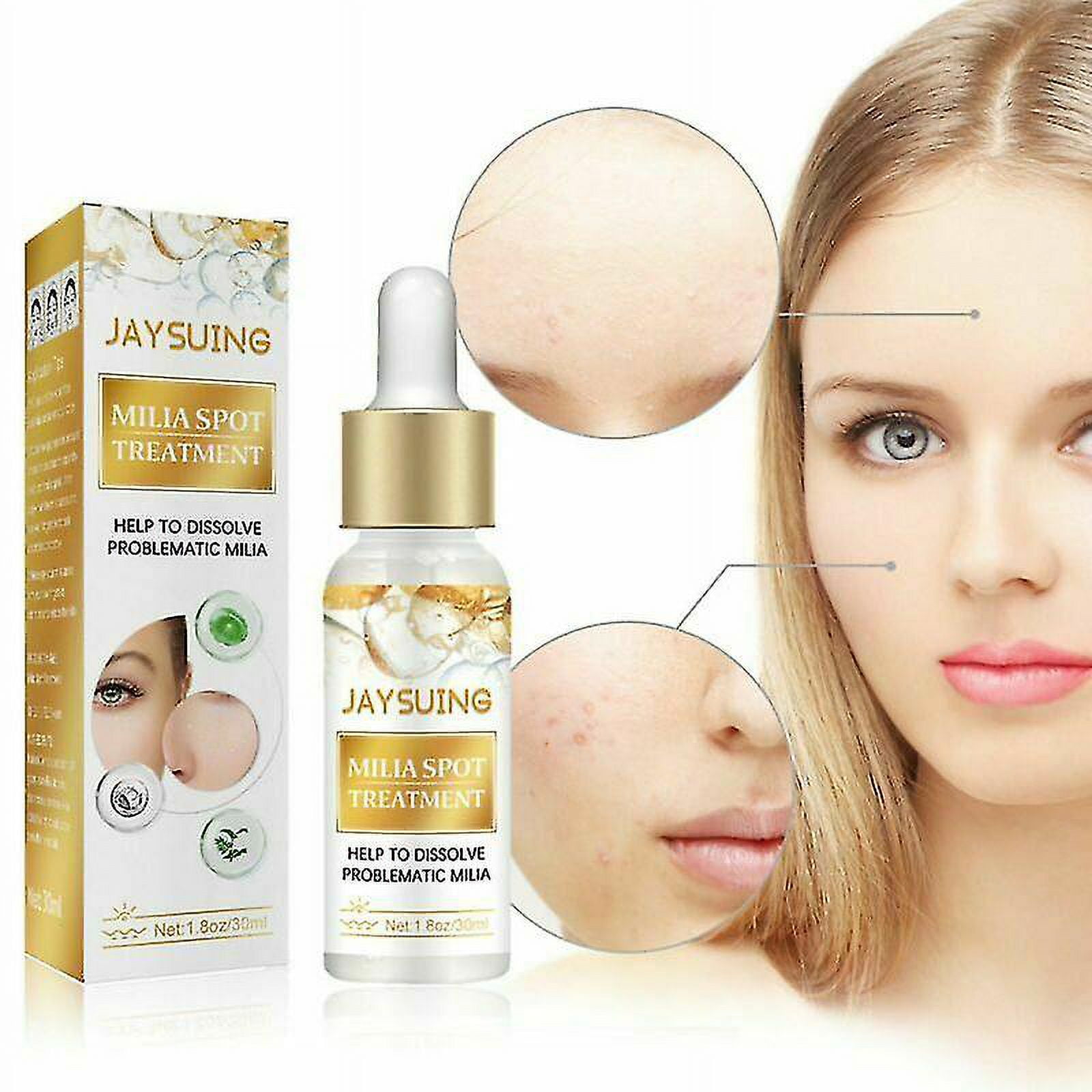 Suero facial para Milia, el tratamiento de manchas removedor de Milia ...