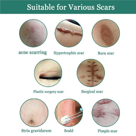 Scar Removal Cream Stretch Mark scar removal Cream Dispel Acne Scars ...