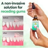 Gum Relief Drops, Gum Therapy Gel For Damaged Gum, Repair Gum Regrowth ...