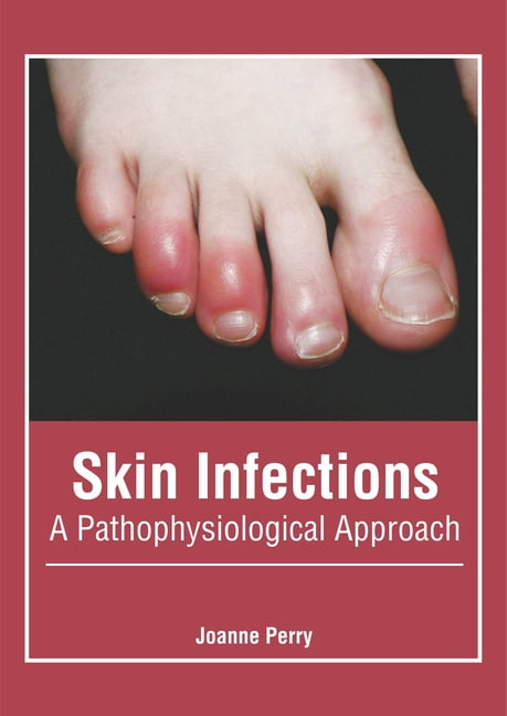Skin Infections: A Pathophysiological Approach (Hardcover) - Walmart.com