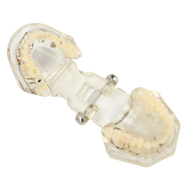 Implant Disease Teeth Model,Transparent Dental Implant Pathological ...