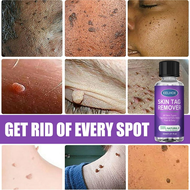 Skin Tag Removal Dr Scholls