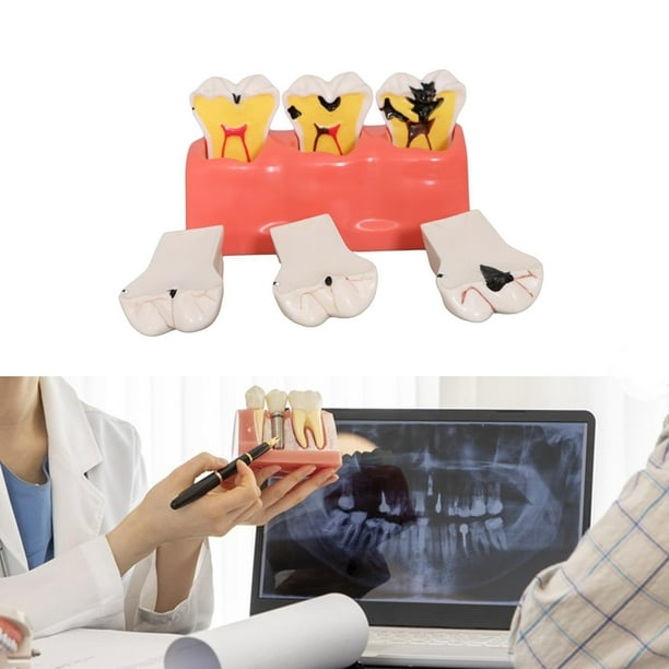 Modelo de dientes de descomposición Educación Modelo de diente Modelo ...