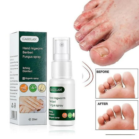 Effective Feet Anti-fungus Cream Treatment Infections Spray Herbal Reve ...