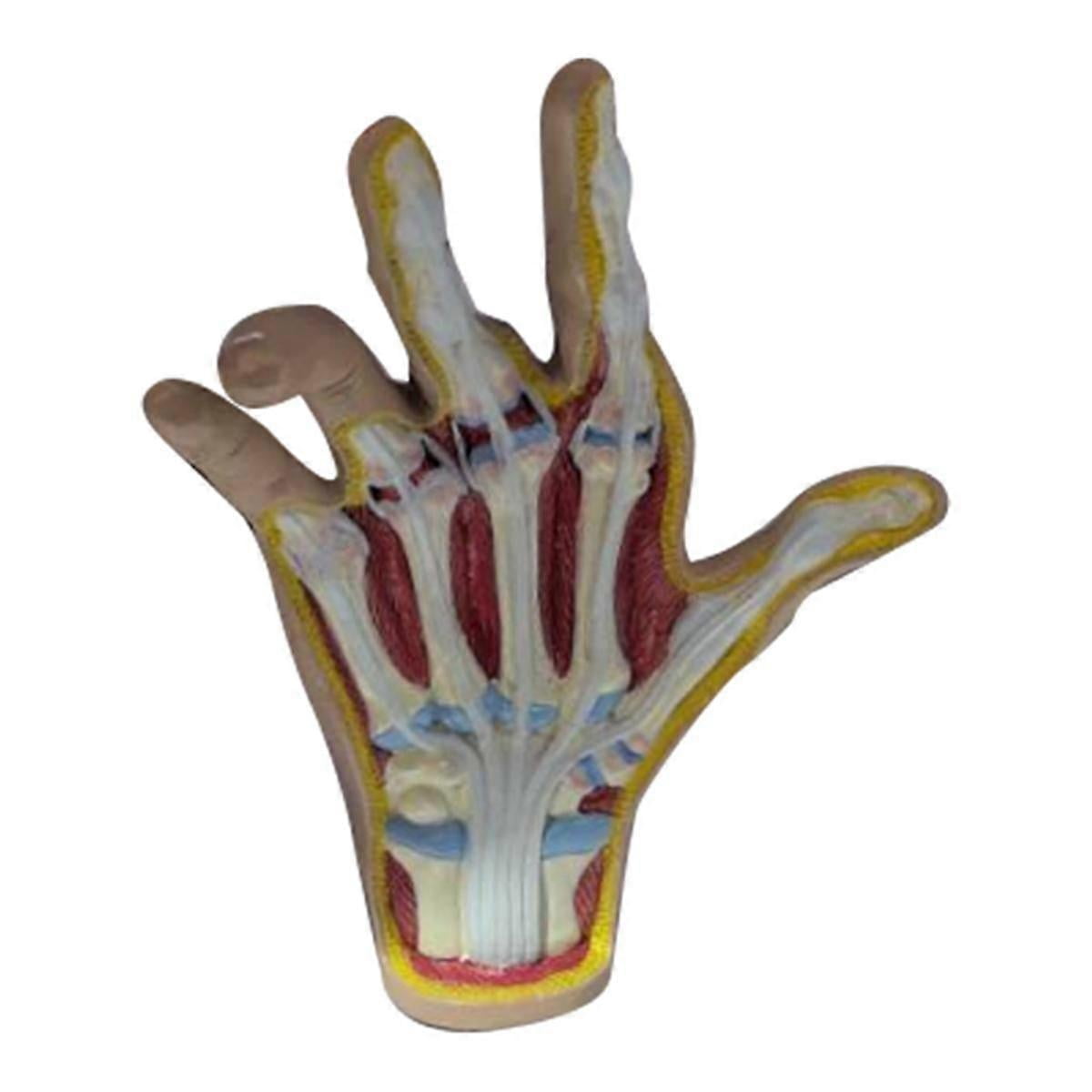 Modèle d'Arthrite de la Main, Modèle de Pathologie de la Main, Anatomie ...