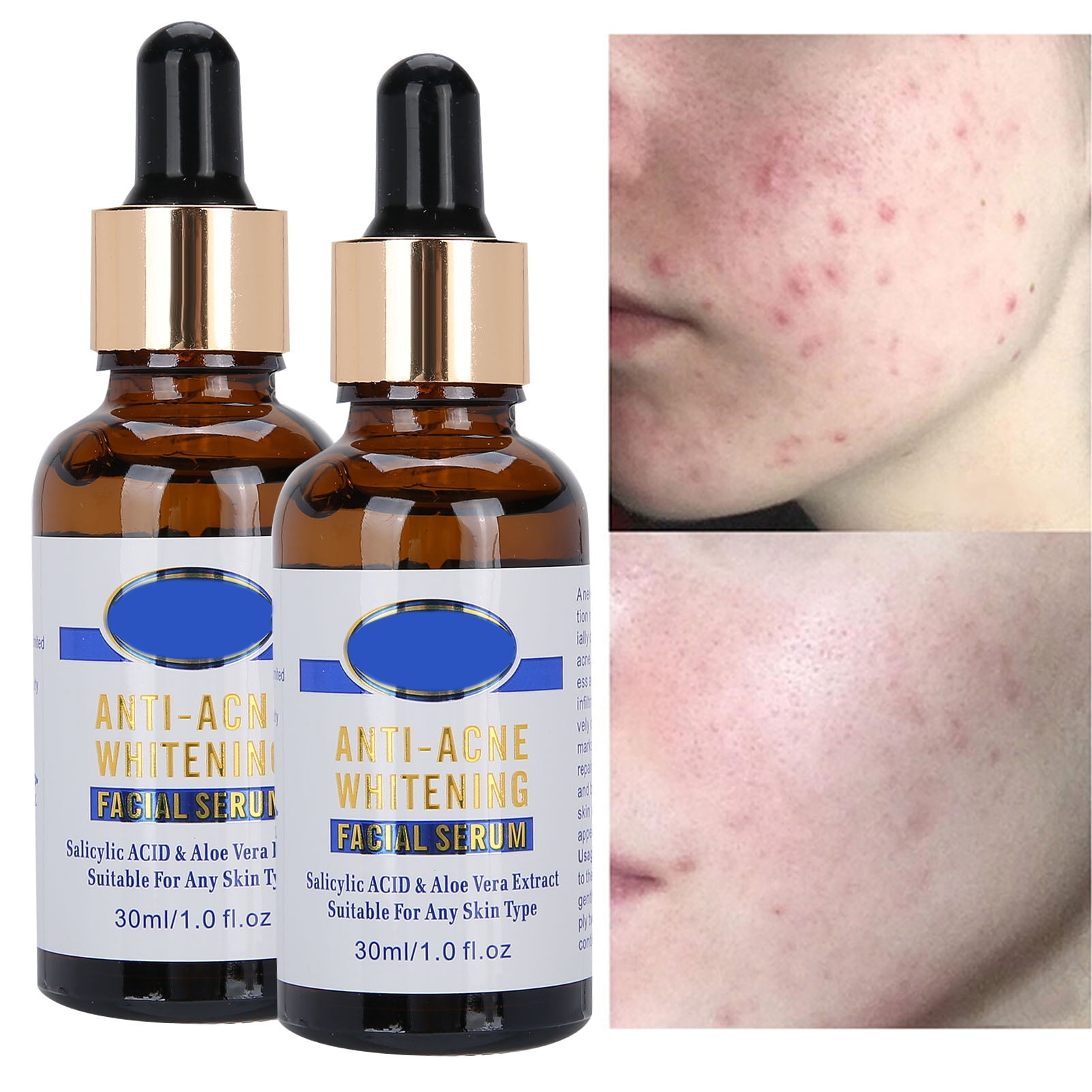 Suero Para Quitar Espinillas, 2 Botellas, Tratamiento Suave Para El ...