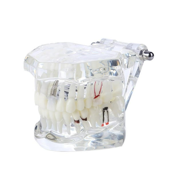 Jinveno PVC Tooth Decay Model Removable Tooth Implant Model Useful ...
