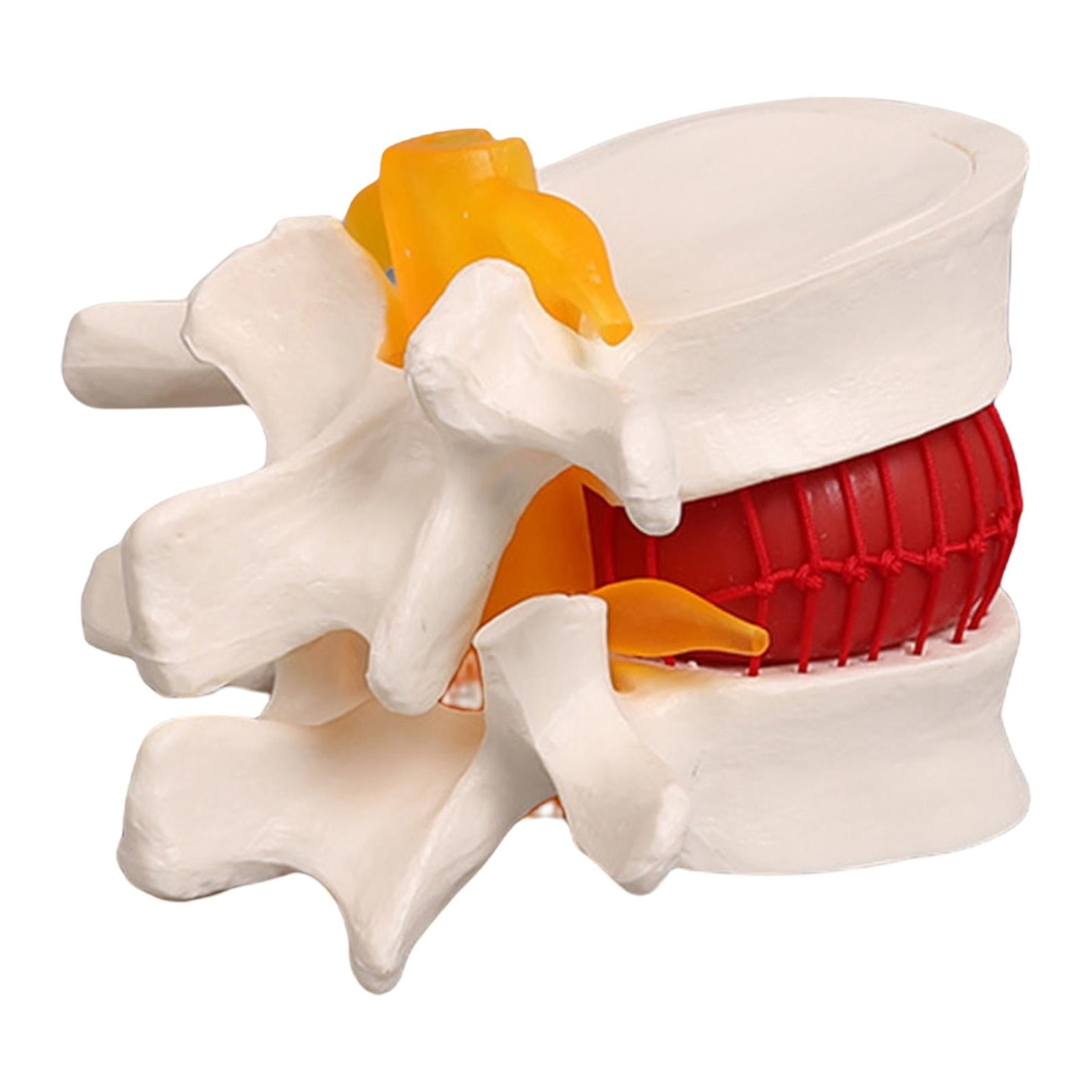 1:1 Disc Herniation Model Spine Model Spine Model for Display - Walmart.com
